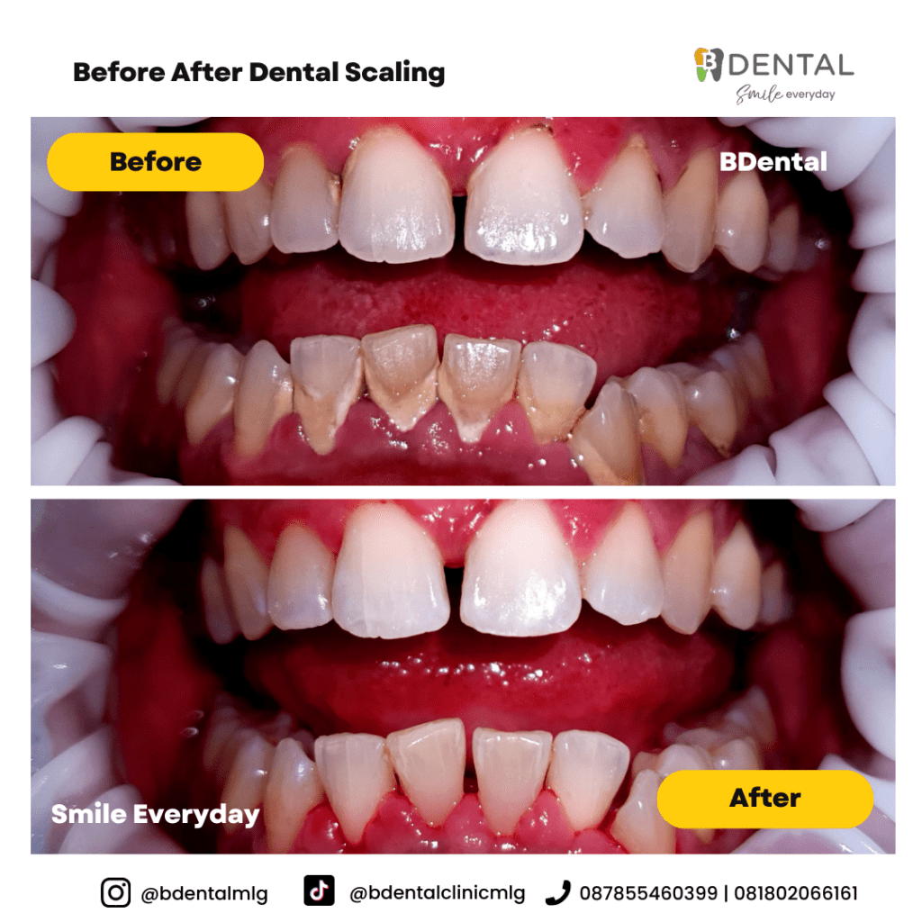 DENTAL SCALING / PEMBERSIHAN KARANG GIGI – Klinik BDental Malang