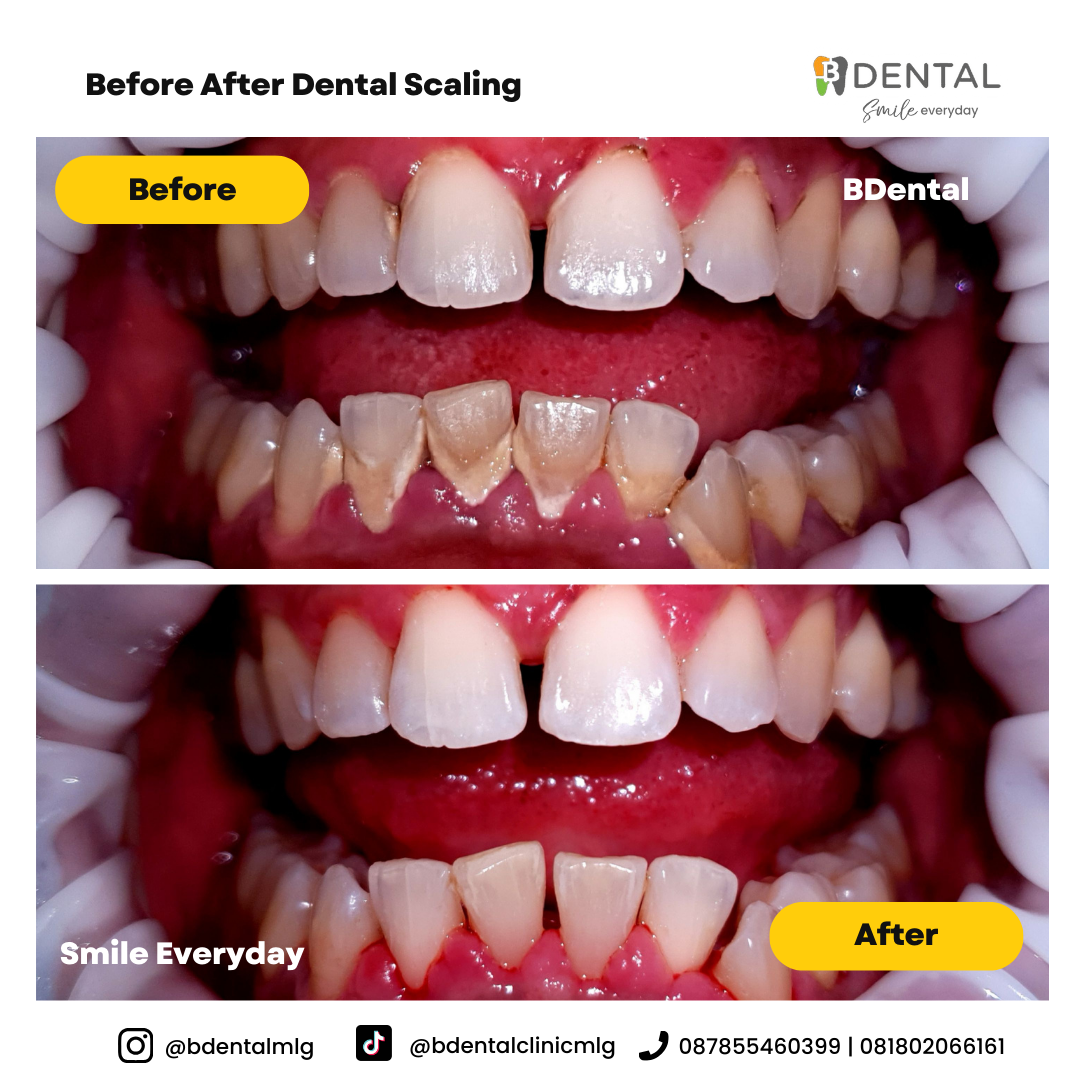 DENTAL SCALING / PEMBERSIHAN KARANG GIGI – Klinik BDental Malang