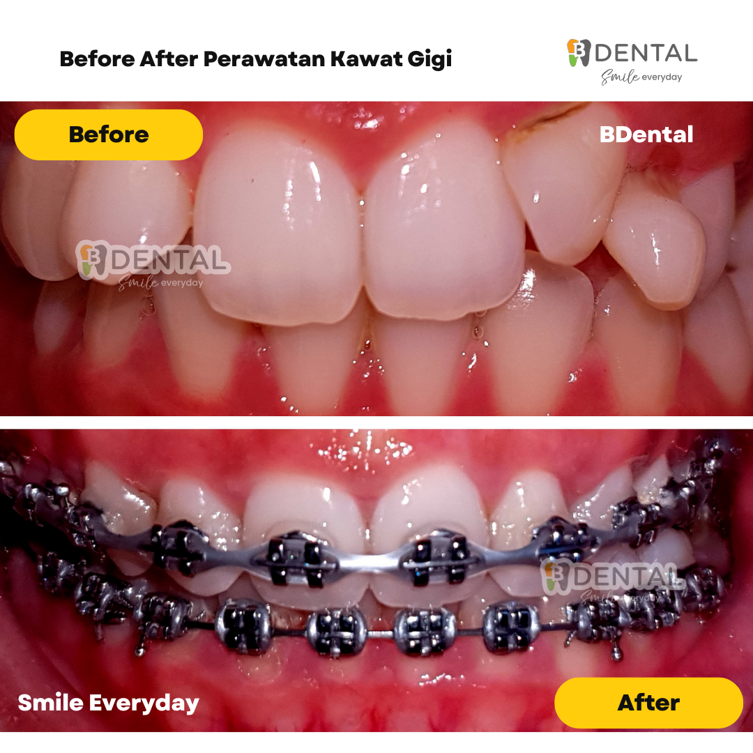 PASANG BEHEL GIGI / KAWAT GIGI – Klinik BDental Malang