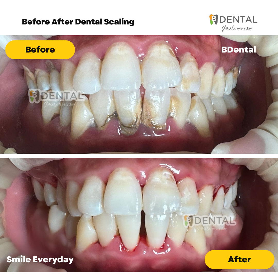 DENTAL SCALING / PEMBERSIHAN KARANG GIGI – Klinik BDental Malang